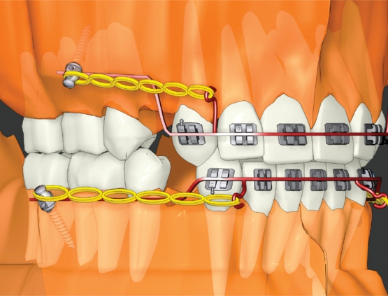 Dentos India: Mini Implants